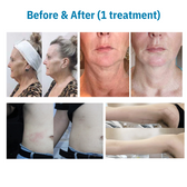 Rejuva 360 Ultra Formation Professional HIFU Machine for Body & Face ...