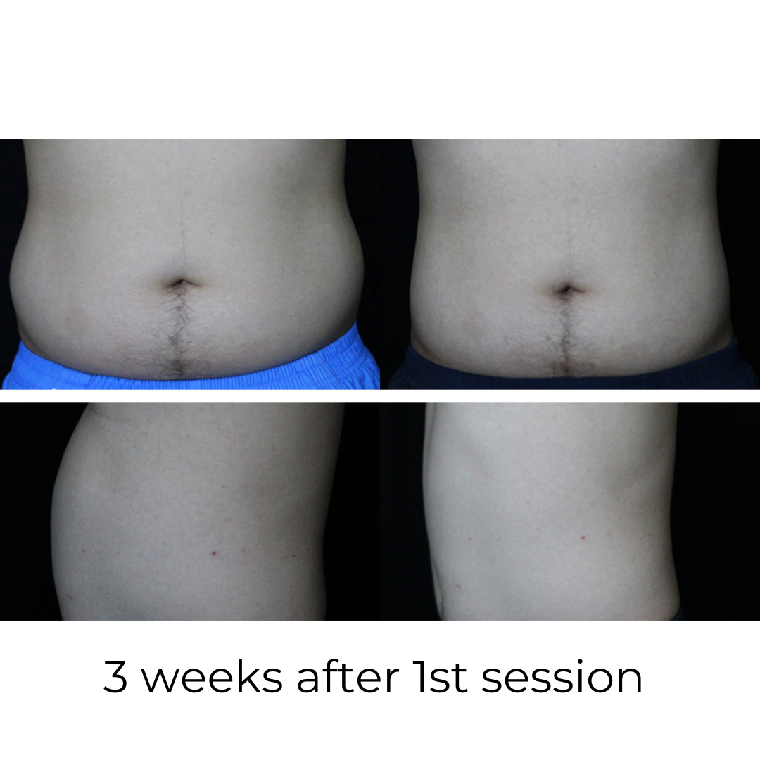 SculptAssure 1060nm Diode Laser Weight Loss Machine | Fast Results Body ...